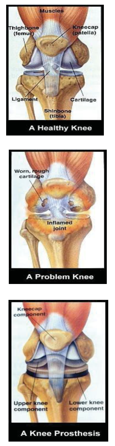 Guide to Faster Recovery:Total Knee Replacement | West Tennessee Bone ...