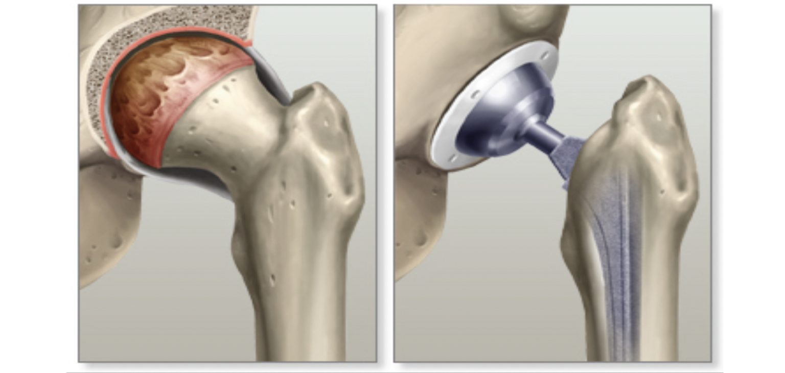 Guide to Faster Recovery:Direct Anterior Hip Replacement | West Tennessee Bone & Joint Institute