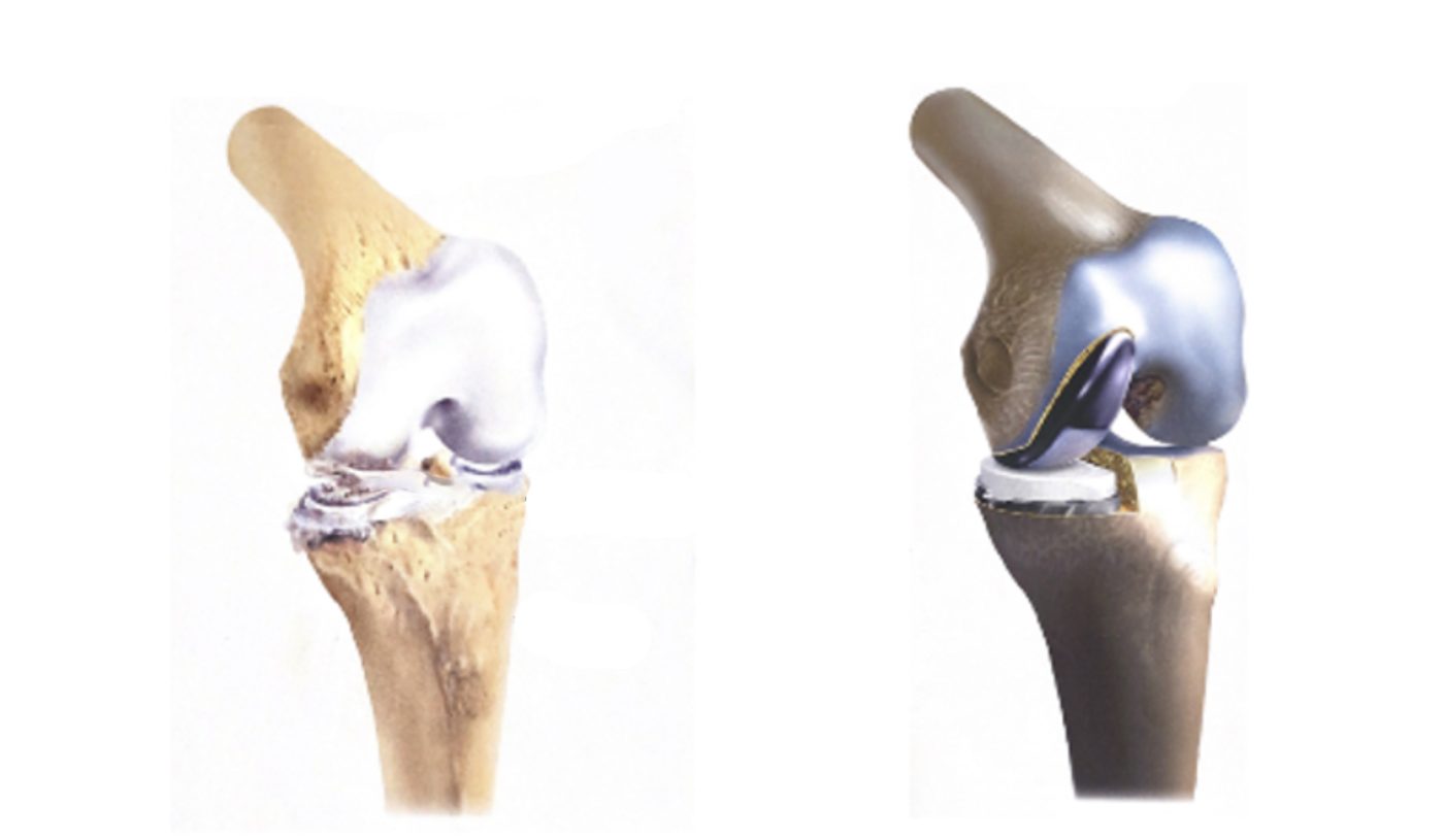 Guide to Faster Recovery:Partial Knee Replacement | West Tennessee Bone ...